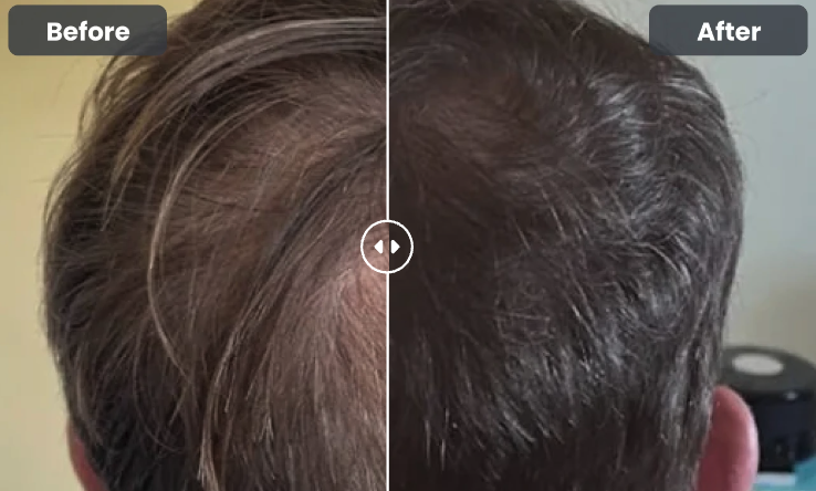 Top 5 Red Light Therapy Devices for Hair Regrowth