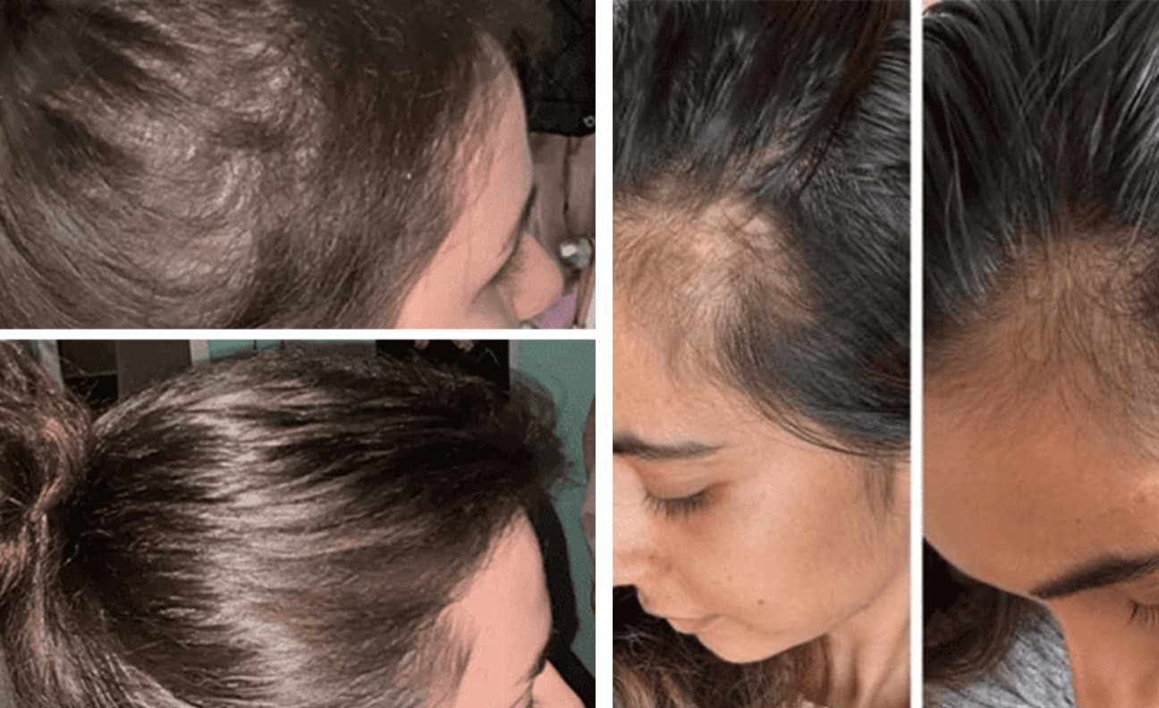 Top 5 Red Light Therapy Scalp Massagers